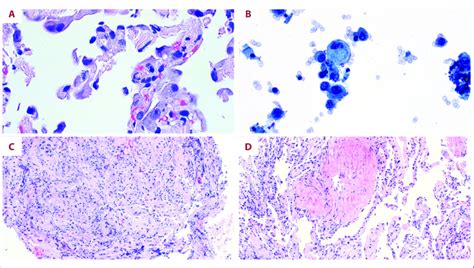 A Transbronchial Lung Biopsies From Left Upper Lung Showing Pulmonary