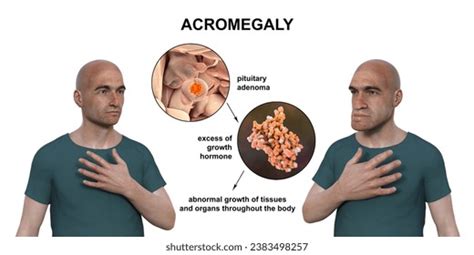 Pituitary Gland Tumor Gigantism