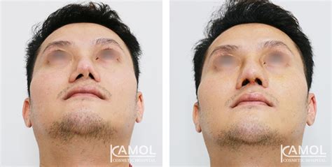 Rhinoplasty Nose Job Revision Rhinoplasty