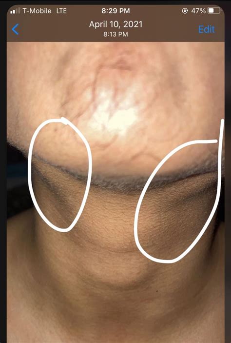 Lymph Nodes Vs Submandibular Glands R Mewing