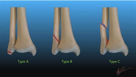 Types Of Fibular Fractures