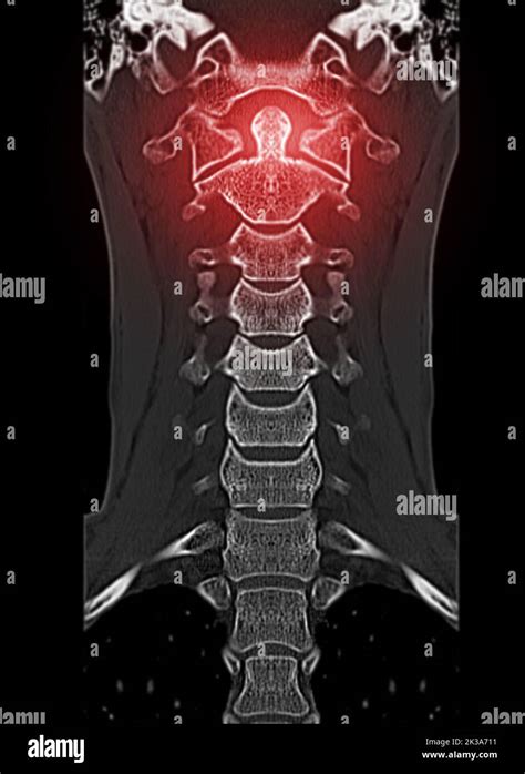 Ct Scan Of C Spine Or Cervical Spine 2d Image For Diagnosis Fracture Of Cervical Spine In Case