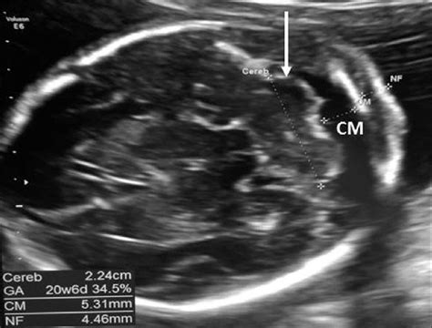 Axial View Of The Fetal Head In The Transcerebellar Plane Showing The