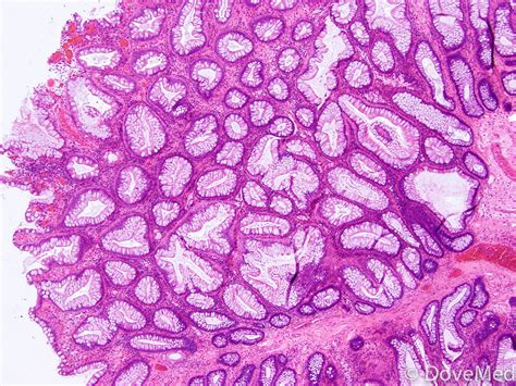 Rectal Polypectomy