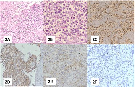 A Histopathology Of Inguinal Lymph Node Showing Tumour Cells H And E Download Scientific