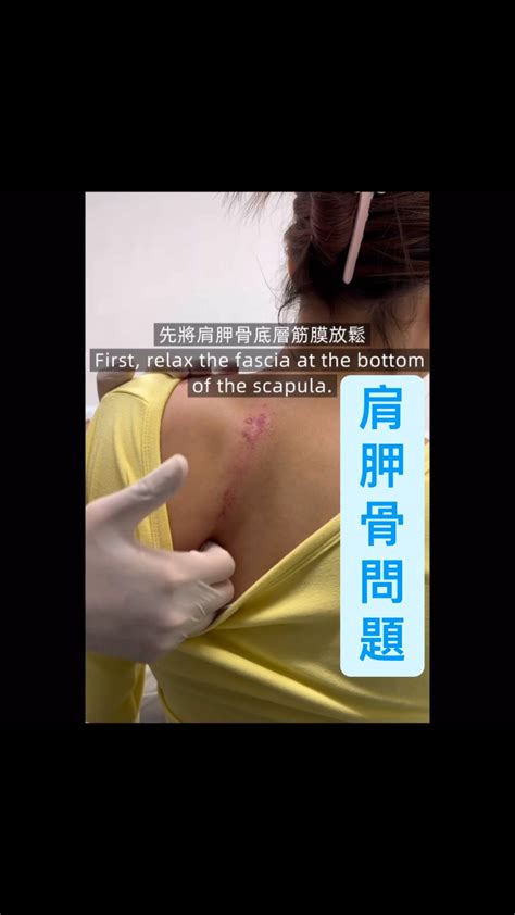 Case Study On Shoulder Blade Pain And Manual Method