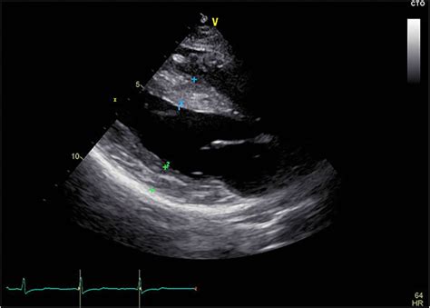 De Novo Lamp2 Insertion Mutation Causes Cardiac Only Danon Disease A