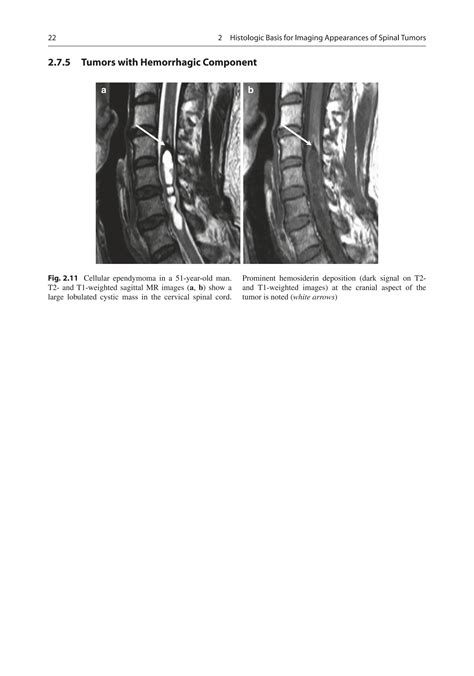 Oncologic Imaging Spine And Spinal Cord Tumorspdf