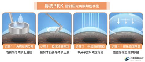 【近視雷射】有刀雷射？無刀雷射？怎麼選？ 白佳欣眼科
