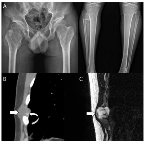Cancers Free Full Text Classification Of Chondrosarcoma From Characteristic To Challenging