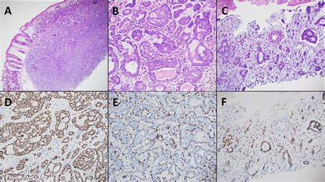Hematoxylin And Eosin Stained Sections Show The Area Of Metastatic