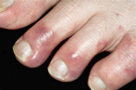 Fluid Filled Bumps Between Toes At Melanie Pena Blog