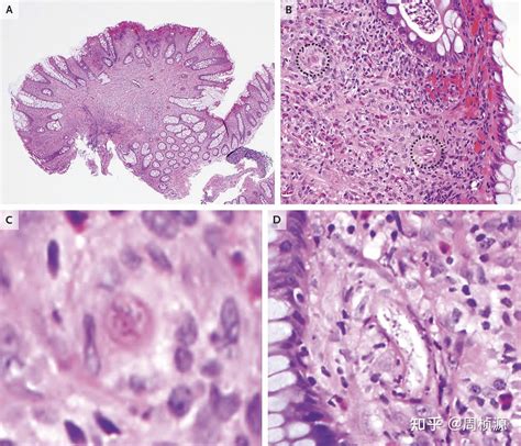 Nejm 2014 Case 28 知乎