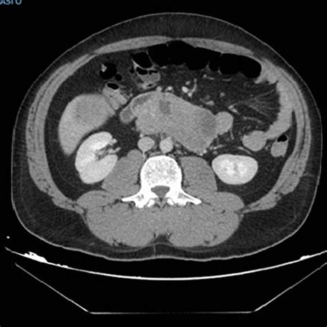 Gastric Gist Tumor A Upper Endoscopy B Tumor Bisected After Excision