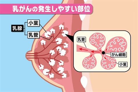 乳がんのこと1歩先へ ススメ：中京テレビ