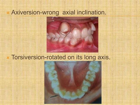 Modifications Of Angle`s Classification Pptx