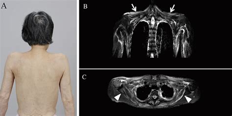 Posterior View Showing Marked Muscle Atrophy Of The Shoulders A And