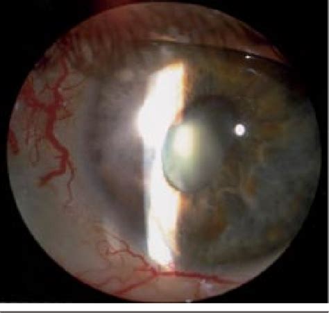 Choroid Plexus Calcification With Mental Retardation Semantic Scholar