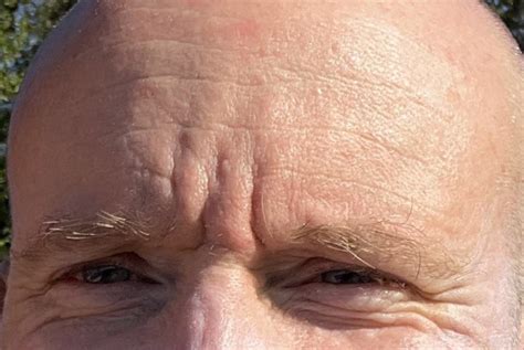 How To Minimize Deep Forehead Wrinkles R 30plusskincare