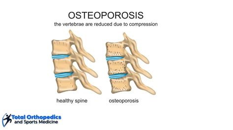 How Do I Strengthen My Back After A Compression Fracture Total Ortho