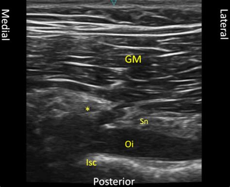 With A Linear Probe We Can Recognize The Anatomical Structures Around Download Scientific