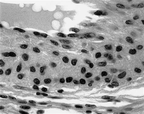 What Is Enlarged Hyperchromatic Nuclei At Doris Boss Blog