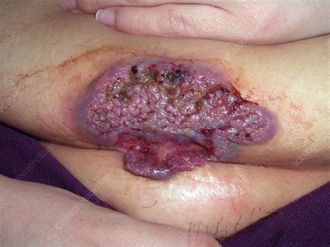 Pyoderma Gangrenosum Stock Image C0565072 Science Photo Library