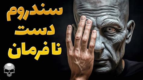 سندروم دست نافرمان نماشا