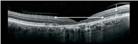 Spectral Domain Optical Coherence Tomography Of The Right Eye Showing Download Scientific
