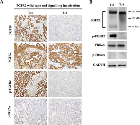 Activated Fgfr2 Signalling As A Biomarker For Selection Of Intrahepatic Cholangiocarcinoma