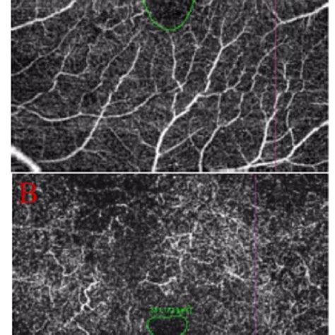 A Ss Oct Horizontal Line Scan Passing Through The Fovea Showing Download Scientific Diagram