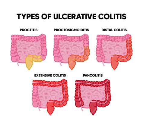 Premium Vector Ulcerative Colitis Types Infographics Including