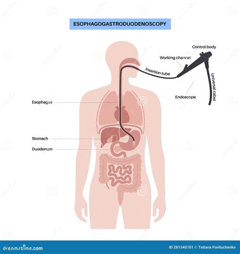 Gastroscopy Endoscopy Procedure Stock Vector Illustration Of Gastroenterology