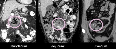 Abdominal Ct Diverticulitis Litfl Radiology Library