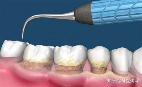 洗牙对牙齿的伤害有多大？ 知乎