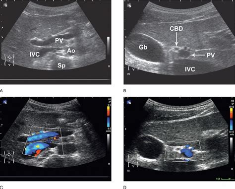 Porta Hepatis Ultrasound Mickey Mouse