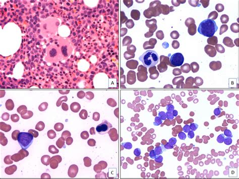 Morphologic Features Of Aml With T 4 12 Q12 P13 Case 5 A The Download Scientific