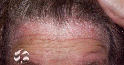 Scalp Psoriasis Image