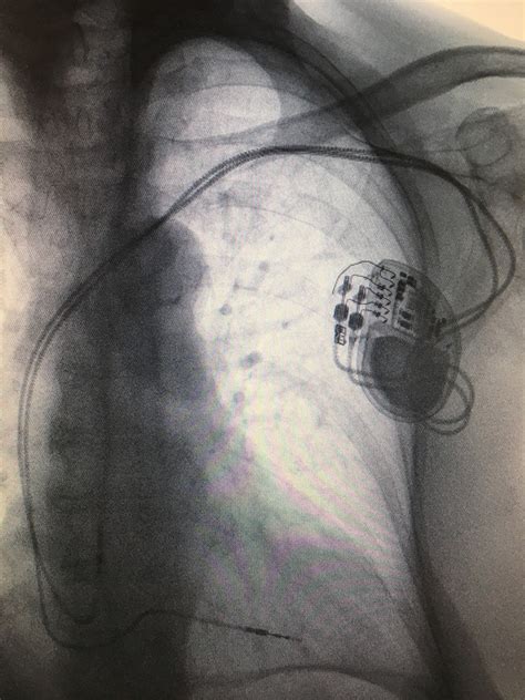 Permanent Pacemaker Ppm Insertion London Cardiac Clinic