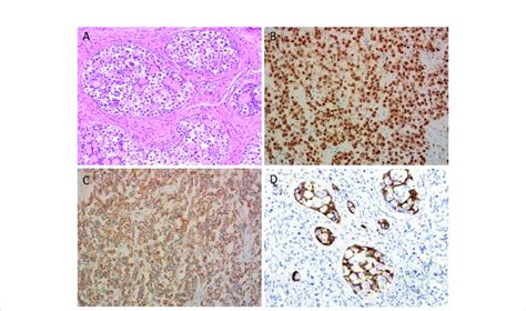 Microscopic View Of The Ovarian Gonadoblastoma With Coexisting
