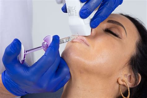 Lip Filler Injections The New Protocol