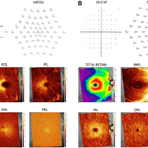 10 2 Visual Field Pattern Deviation Plot Local Responses On Regular