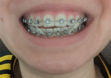 Moved Onto Elastics Finally To Close Open Bite Rbraces