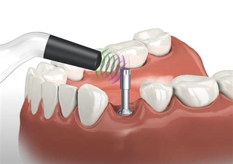 New Design Of Measuring Instruments For Dental Implants Together Tech