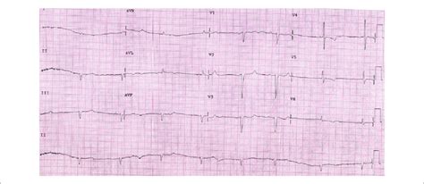 Ecg Sinus Bradycardia Low Voltage Qrs Complexes In The Frontal Plane