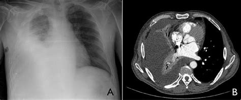 Initial Chest Radiograph A And Ct B Showing A Large Loculated Download Scientific Diagram