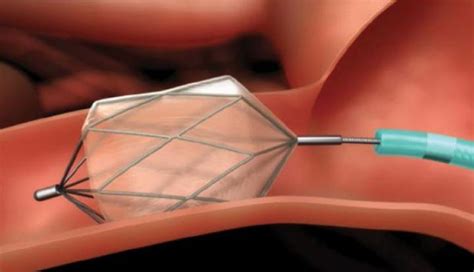 Occlusion Devices Market Analysis Key Players Share Dynamic Demand And Consumption By 2024 To 2033