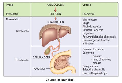 Causes Of Jaundice Prehepatic Intrahepatic Extrahepatic Diagnosis