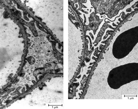 Glomerular Filtration Barrier Permeability At Ricky Cannon Blog