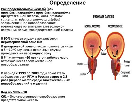 Рак предстательной железы презентация онлайн